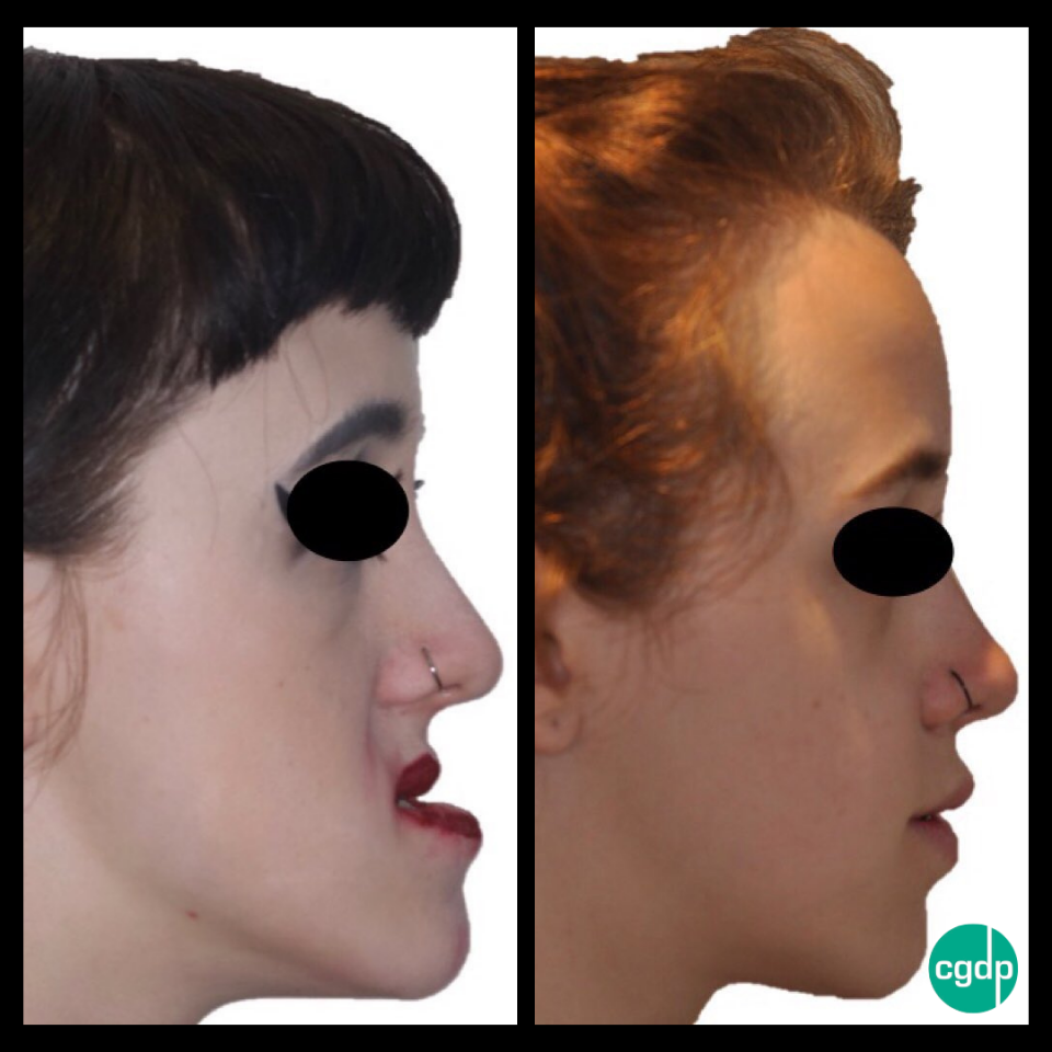 The why, how and what of jaw surgery - Covent Garden Dental Practice