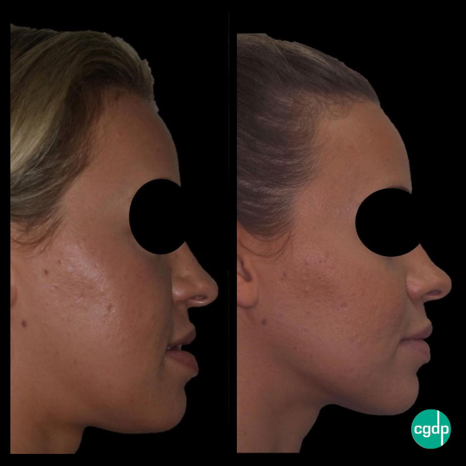 The why, how and what of jaw surgery - Covent Garden Dental Practice