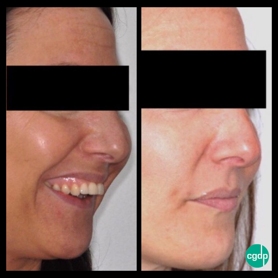 The why, how and what of jaw surgery - Covent Garden Dental Practice